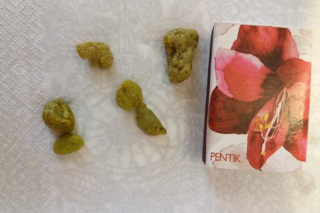 Tällä kotikonstilla poistat sappikivesi ilman leikkausta - Akupunktio Lähde